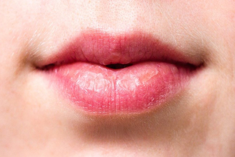 6 causas de aparición de boqueras | esVivir